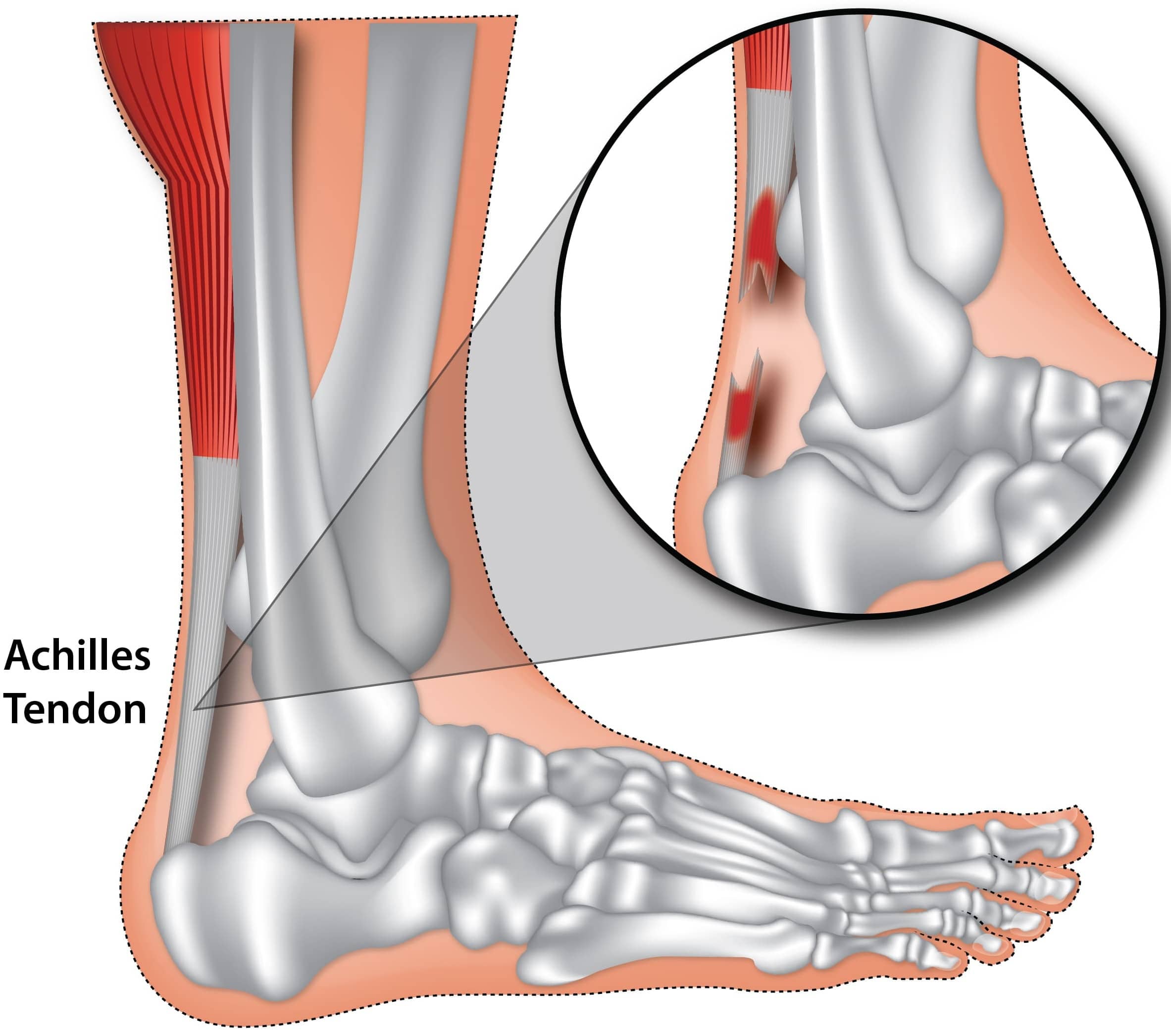 Achilles Tendon Rupture Information And Help SportNova UK DaftSex HD