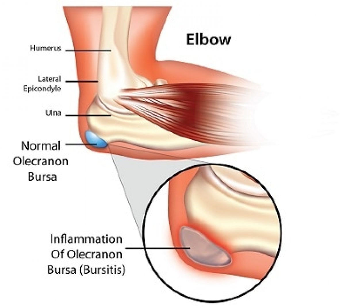Olecranon Bursitis What Does Elbow Bursitis Look & Feel Like?