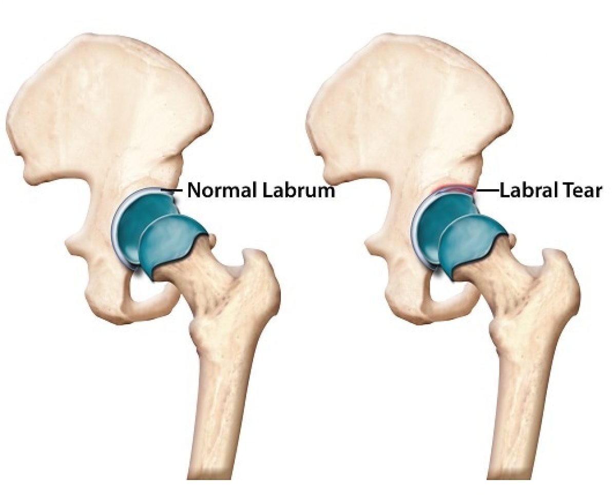 Acetabular Labrum