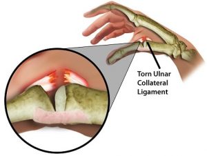 Sprained Thumb - Causes, Symptoms and Treatment | SportNova UK